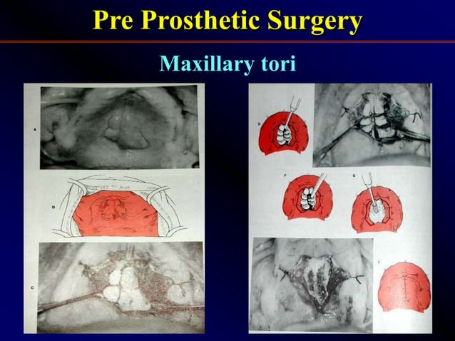 omfs- PreProsthetic Surgery for fabrication of prosthesis.ppt