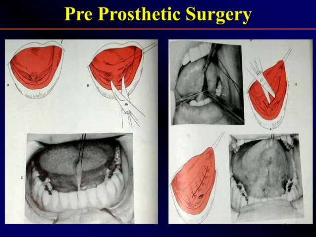 omfs- PreProsthetic Surgery for fabrication of prosthesis.ppt