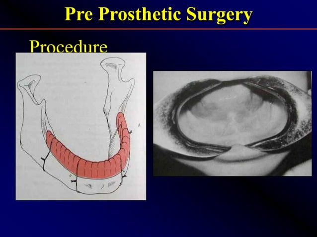 omfs- PreProsthetic Surgery for fabrication of prosthesis.ppt