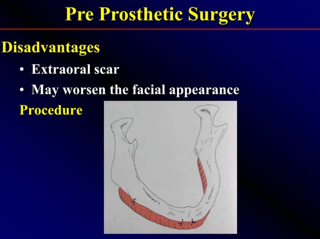omfs- PreProsthetic Surgery for fabrication of prosthesis.ppt