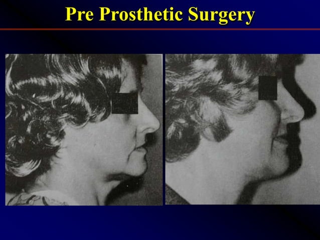 omfs- PreProsthetic Surgery for fabrication of prosthesis.ppt