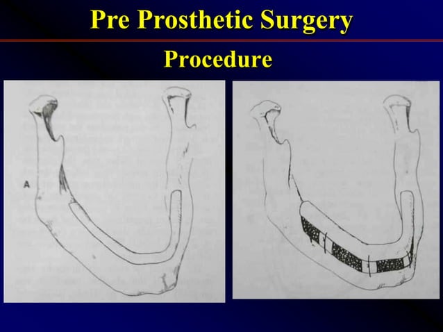 omfs- PreProsthetic Surgery for fabrication of prosthesis.ppt