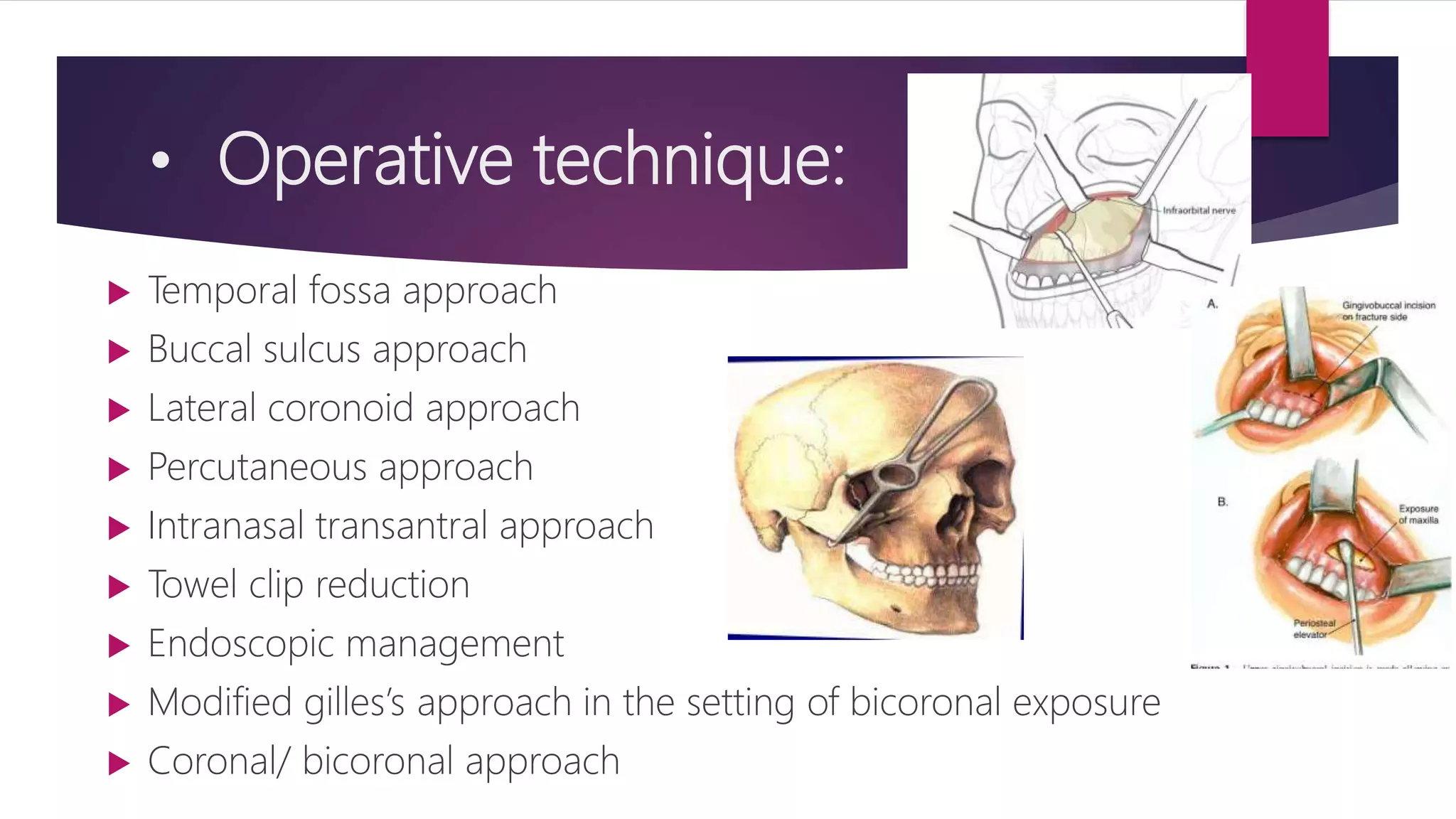 fractures of zygomatic bone | PPTX
