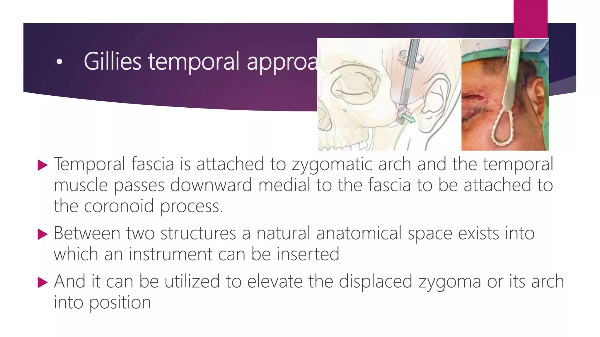 fractures of zygomatic bone | PPTX