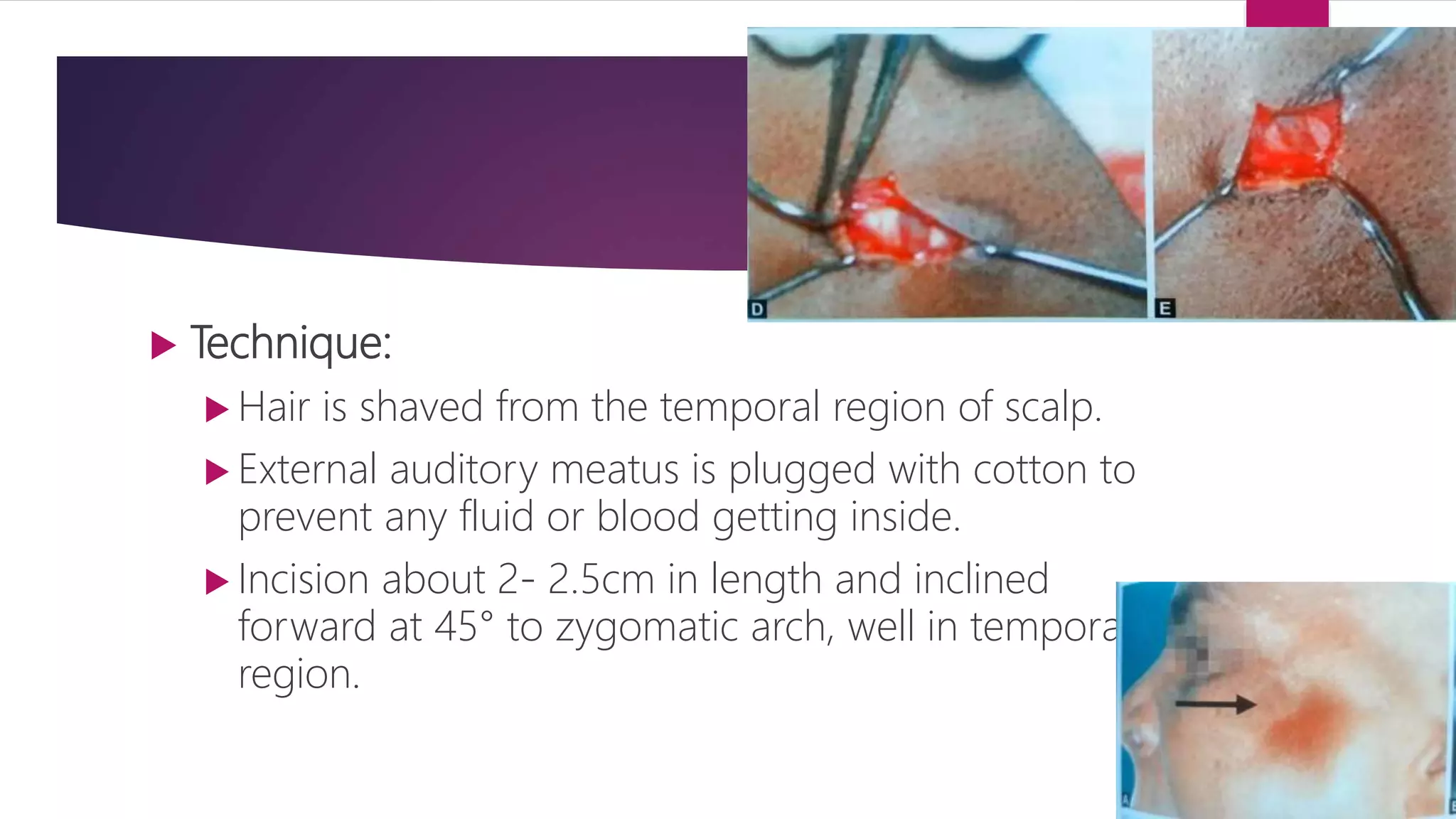 fractures of zygomatic bone | PPTX