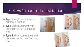 fractures of zygomatic bone | PPTX | Death, Injury, or Military ...