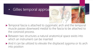 fractures of zygomatic bone | PPTX