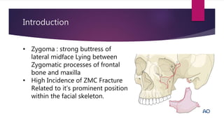 fractures of zygomatic bone | PPTX