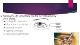 fractures of zygomatic bone | PPTX | Death, Injury, or Military ...