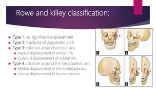 fractures of zygomatic bone | PPTX | Death, Injury, or Military ...