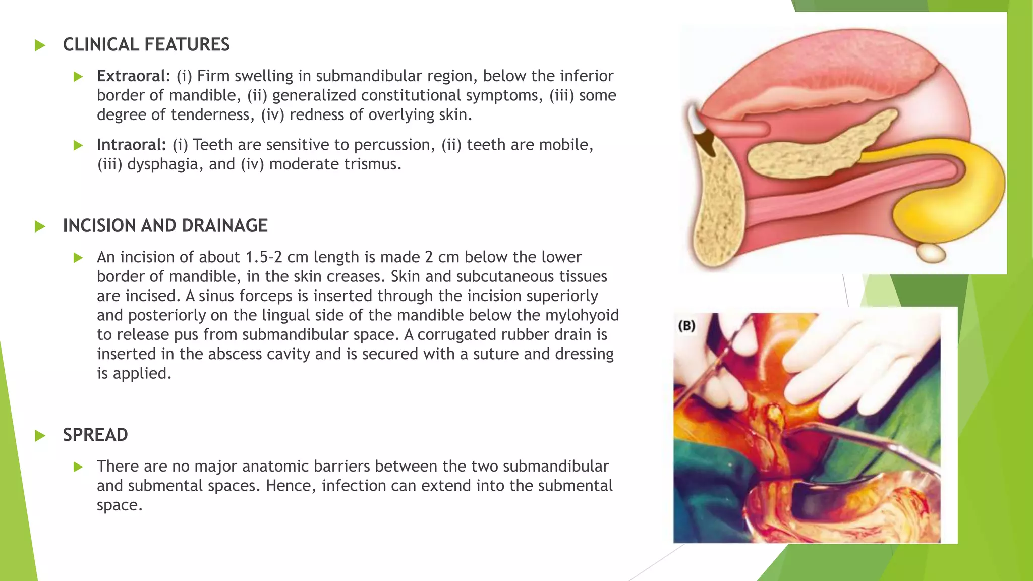 OMFS mandibular space infection.pptx