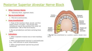omfs maxillary inj tech.pptx