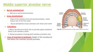 omfs maxillary inj tech.pptx