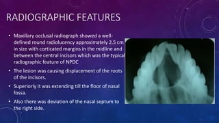 Nasopalatine duct cyst | PPTX