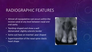 Nasopalatine duct cyst | PPTX