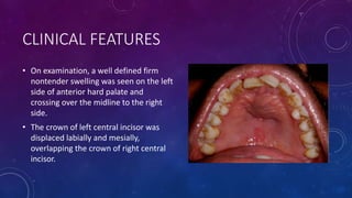 Nasopalatine duct cyst | PPTX