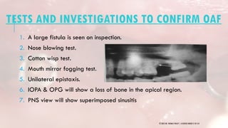 Oroantral Fistula and Management in Oral & Maxillofacial Surgery.pptx