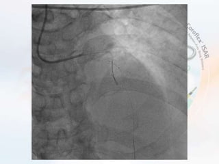 HYBRID DEB AND DES PCI | PPTX
