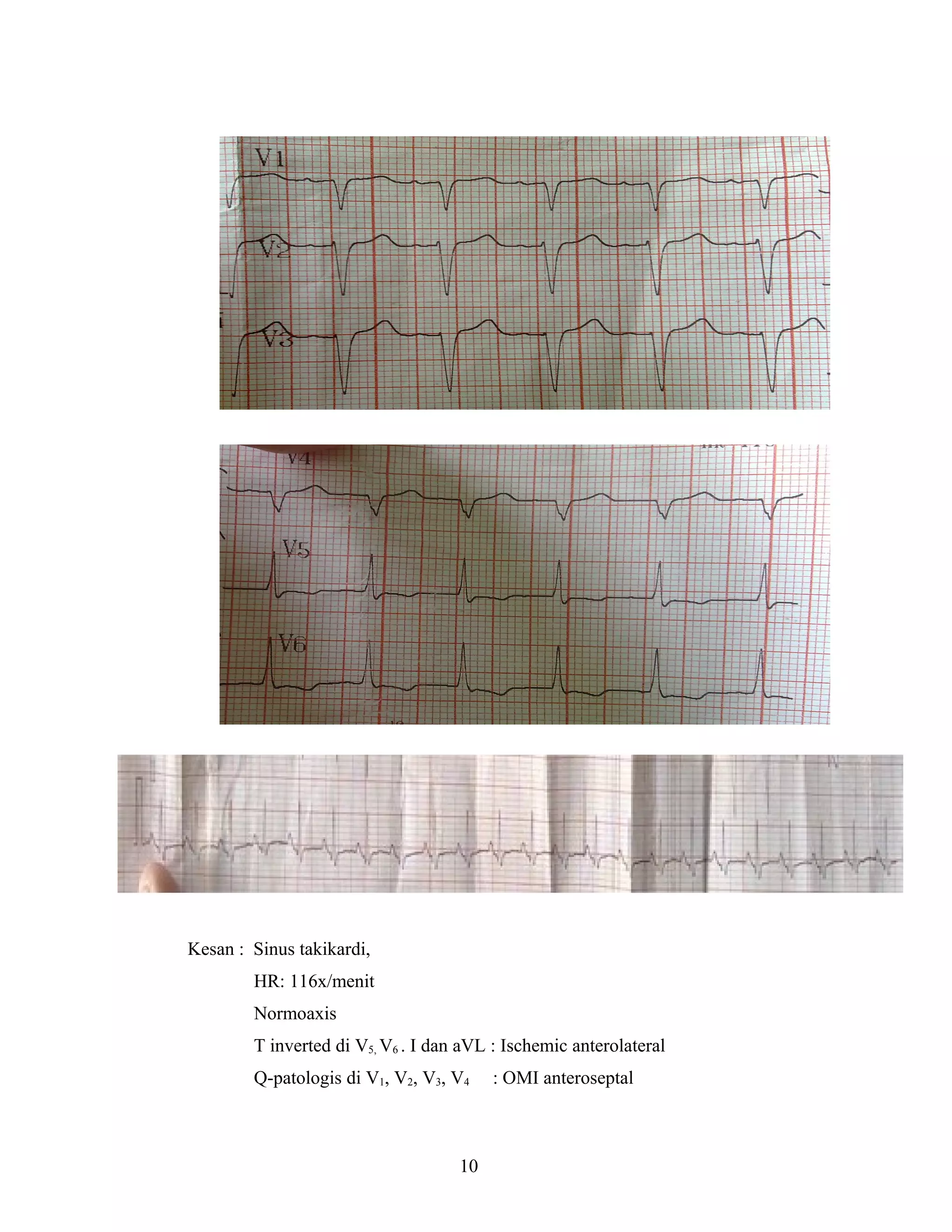 Omi anteroseptal dan hypertension heart disease (hhd) | DOC