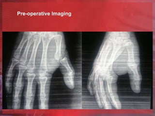 Floating thumb | PPT