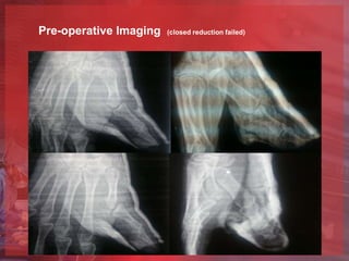 Floating thumb | PPT