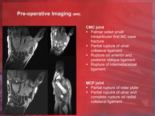 Floating thumb | PPT