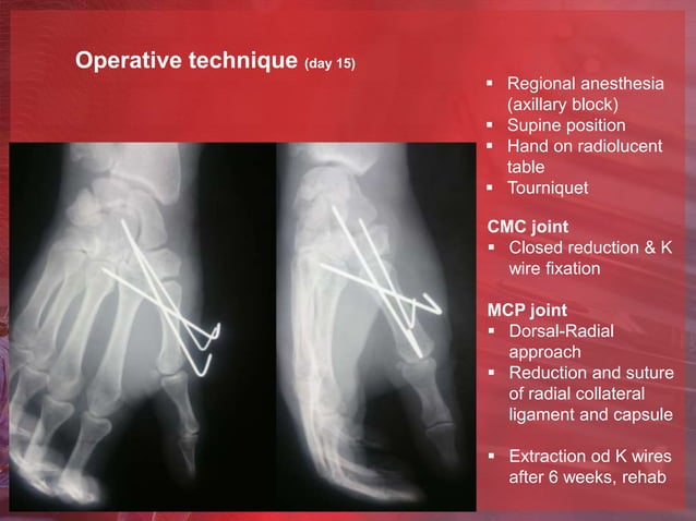 Floating thumb | PPT
