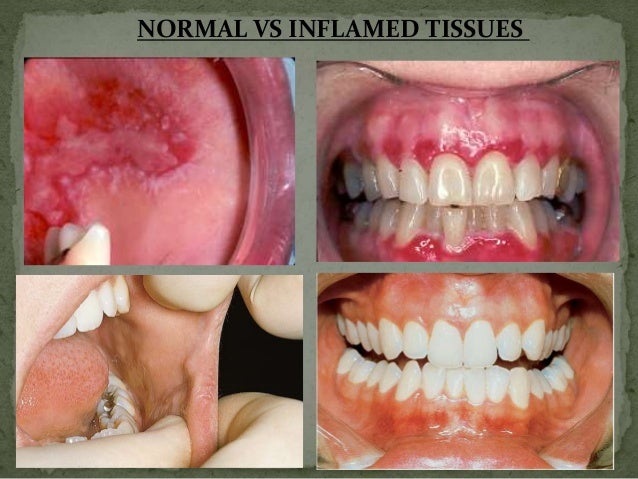 Oral mucous membrane