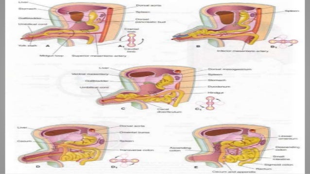 Omphalocele vs gastroschisis