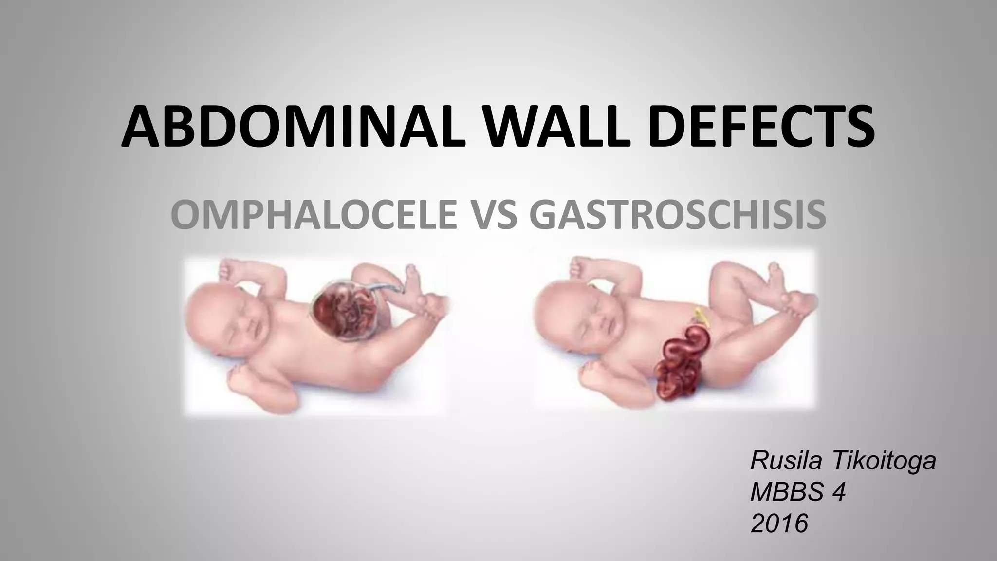 OMPHALOCELE VS GASTROSCHISIS.pdf