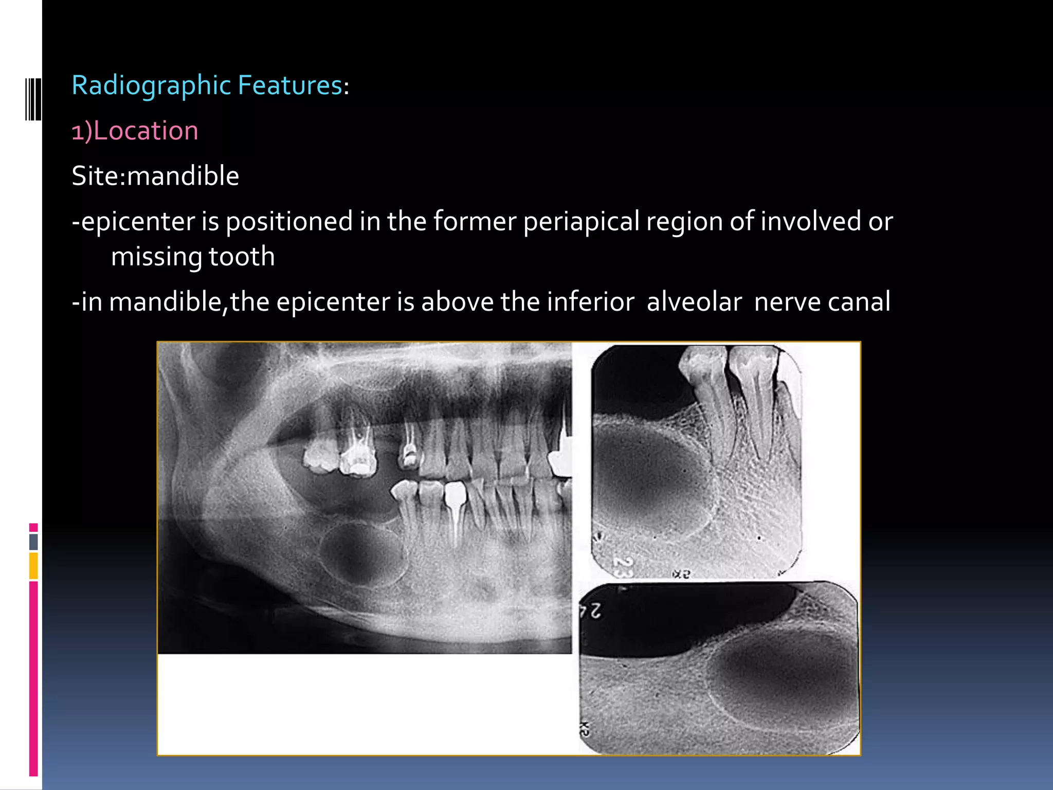 OROFACIAL CYST | PPT