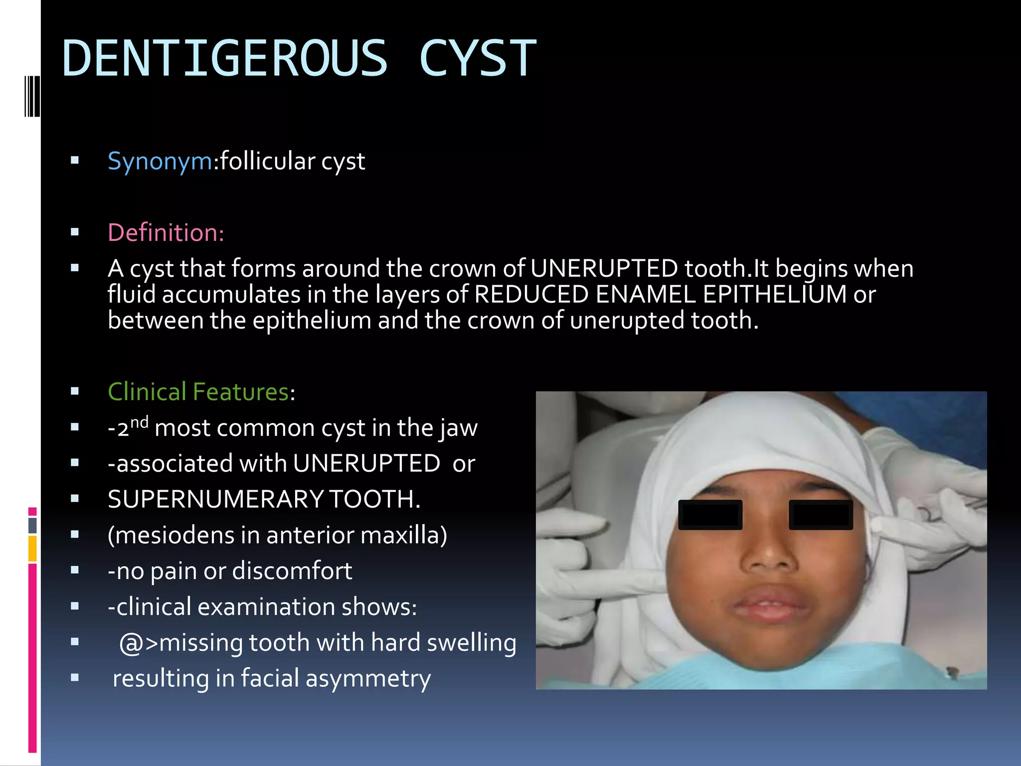 OROFACIAL CYST | PPT