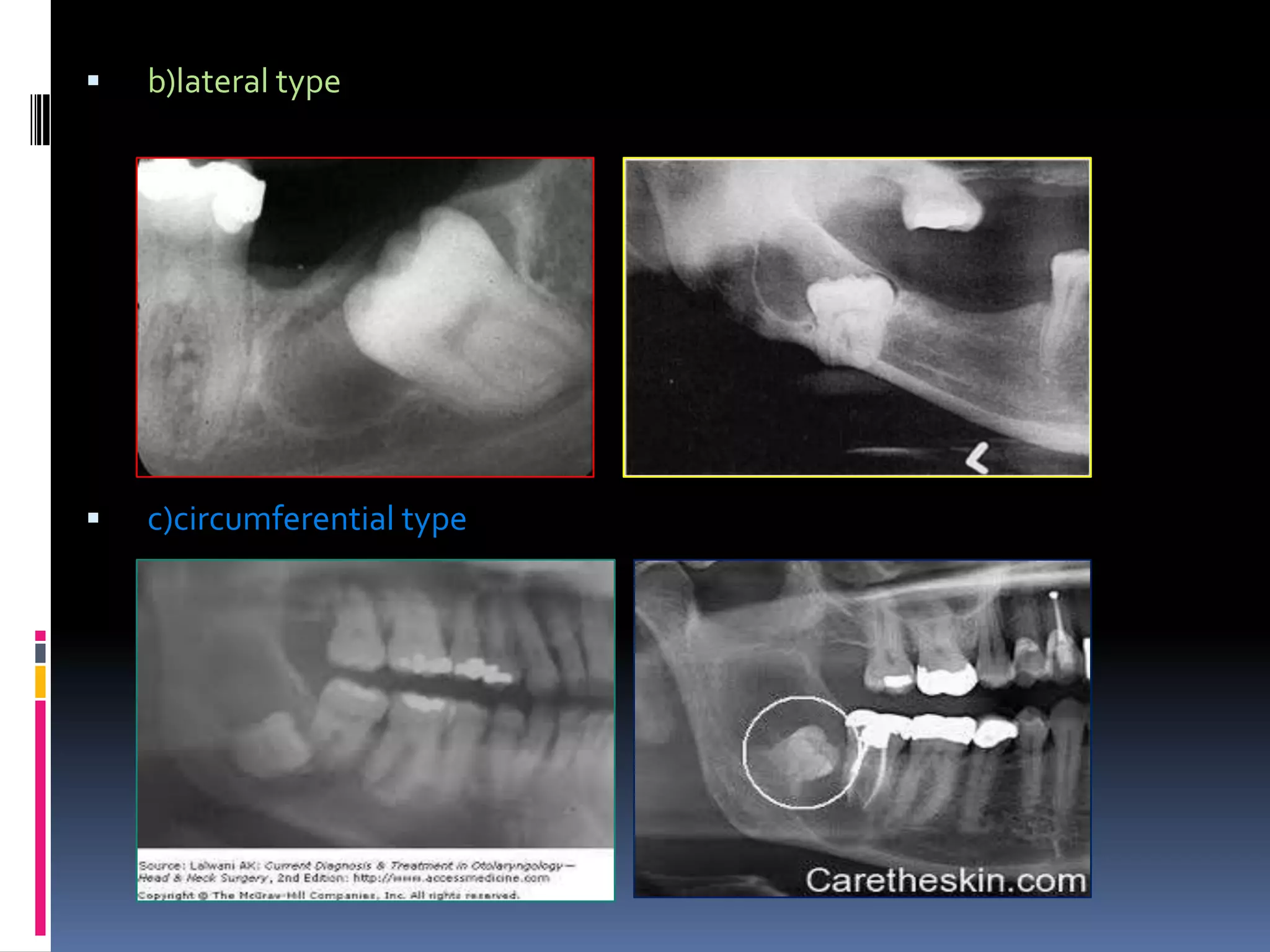 OROFACIAL CYST | PPT