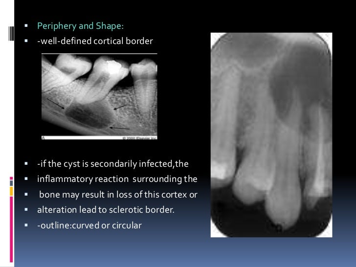 OROFACIAL CYST