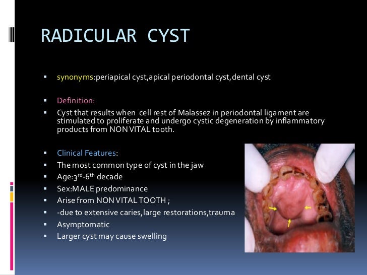 Orofacial Cyst Cysts In Orofacial Region