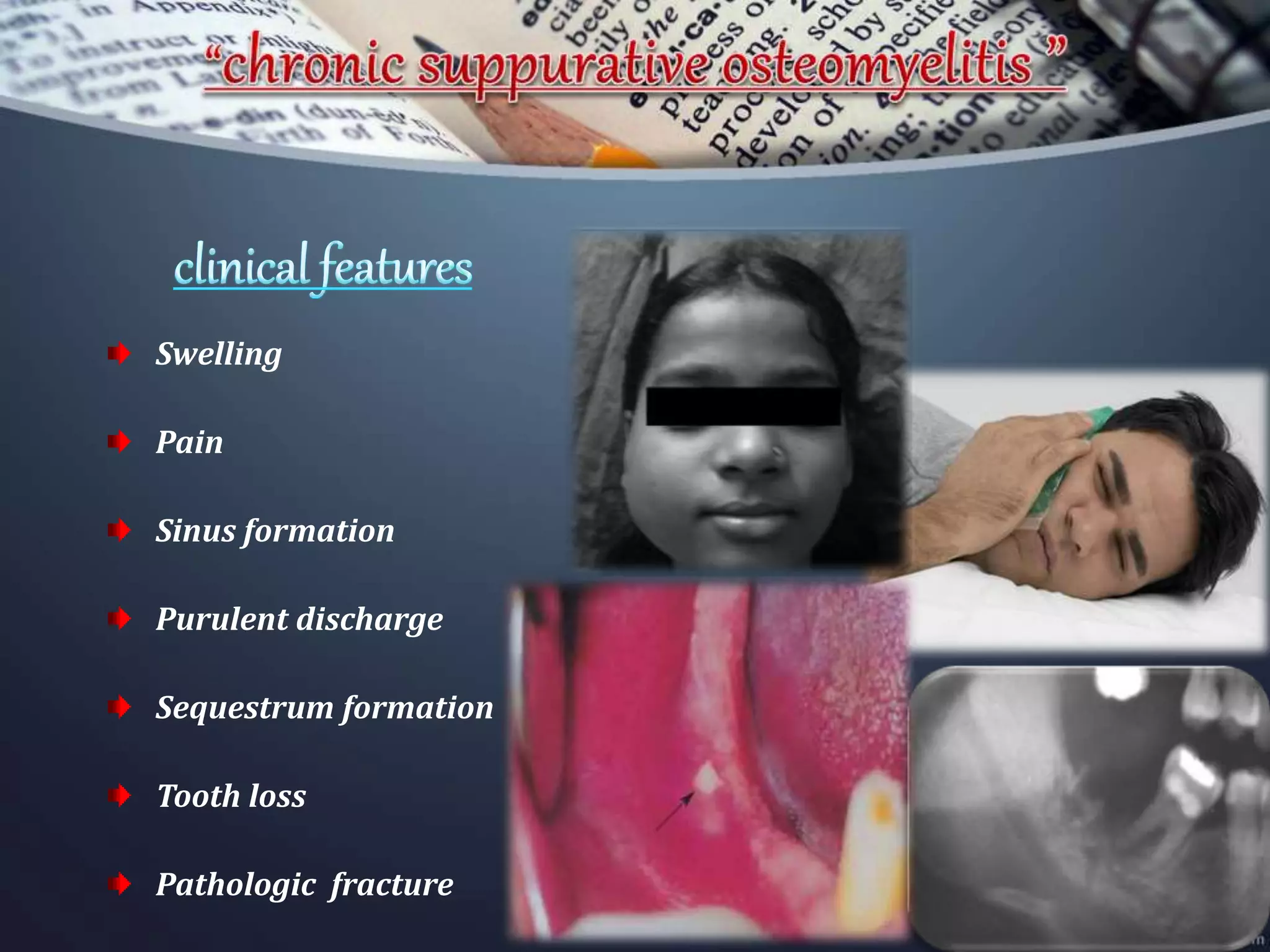 Osteomyelitis of jaw--department of oral medicine and radiology | PPTX