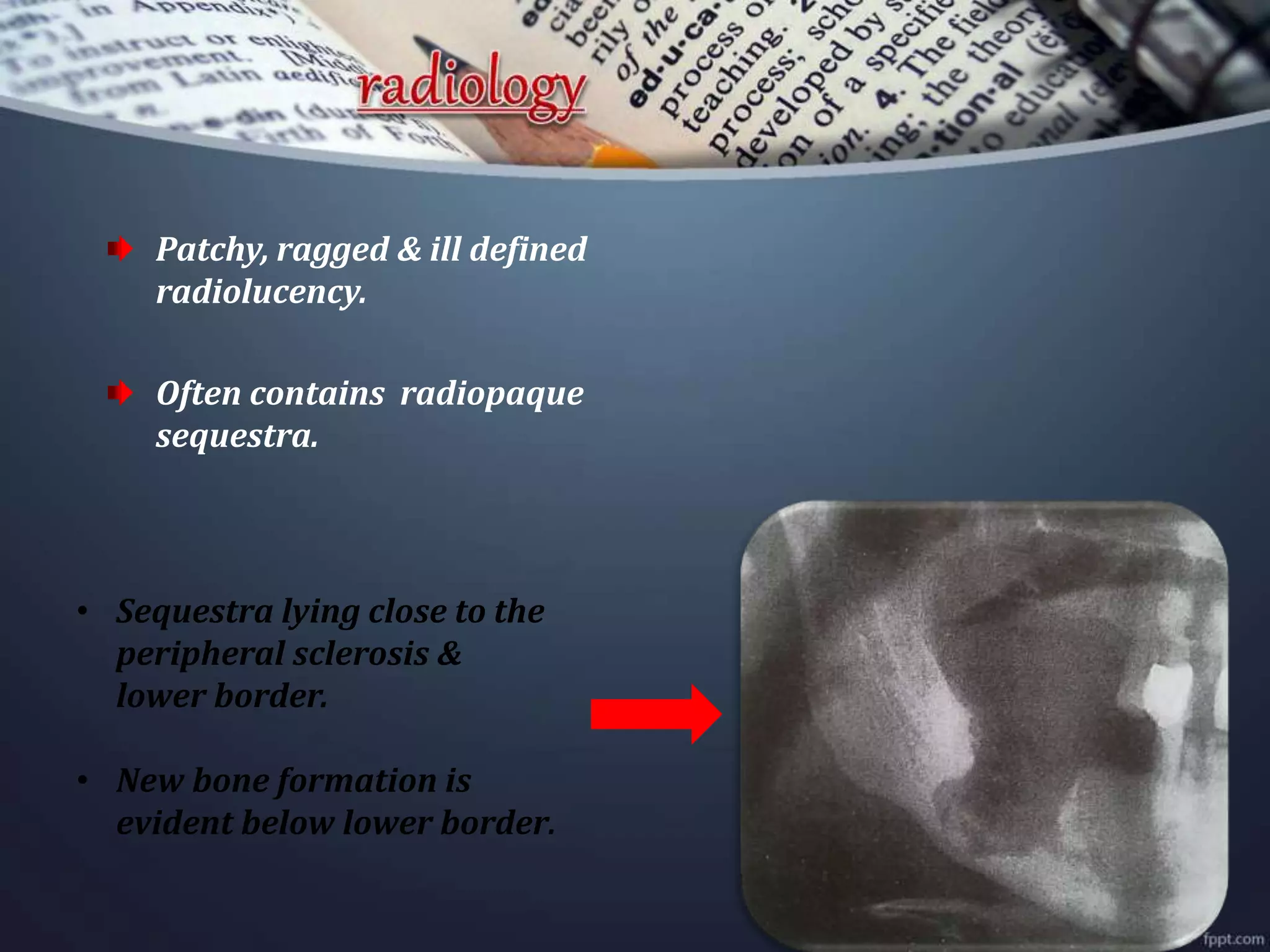 Osteomyelitis of jaw--department of oral medicine and radiology | PPTX