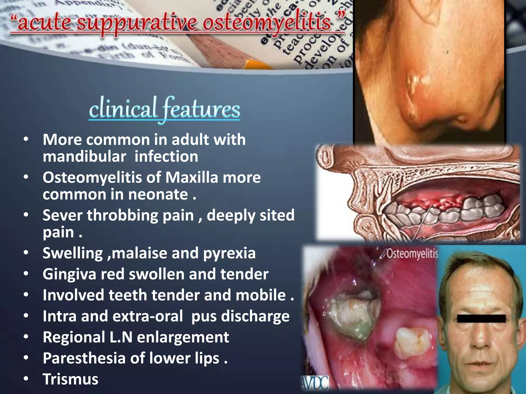 Osteomyelitis of jaw--department of oral medicine and radiology | PPTX