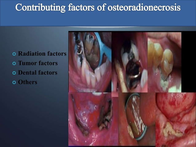Osteomyelitis of jaw--department of oral medicine and radiology | PPTX