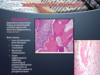 Osteomyelitis of jaw--department of oral medicine and radiology | PPTX