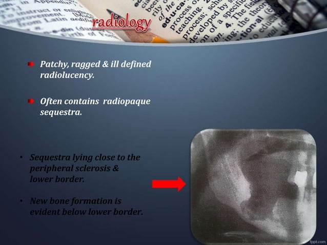 Osteomyelitis Of Jaw Department Of Oral Medicine And Radiology