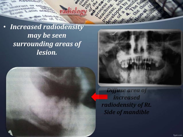 Osteomyelitis Of Jaw Department Of Oral Medicine And Radiology