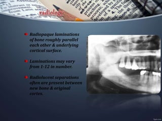 Osteomyelitis Jaw Radiographic Appearance