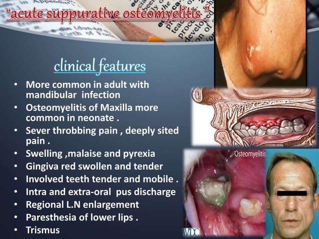 Osteomyelitis Of Jaw Department Of Oral Medicine And Radiology