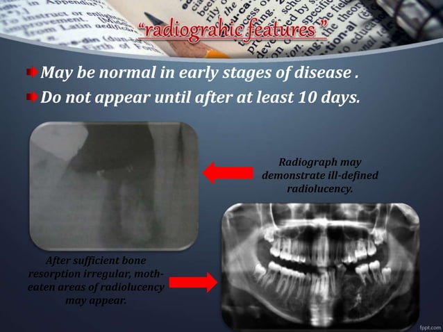 Osteomyelitis Of Jaw Department Of Oral Medicine And Radiology