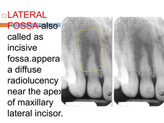 NORMAL RADIOGRAPHIC LANDMARKS | PPTX