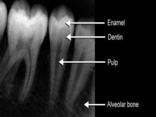 NORMAL RADIOGRAPHIC LANDMARKS | PPTX