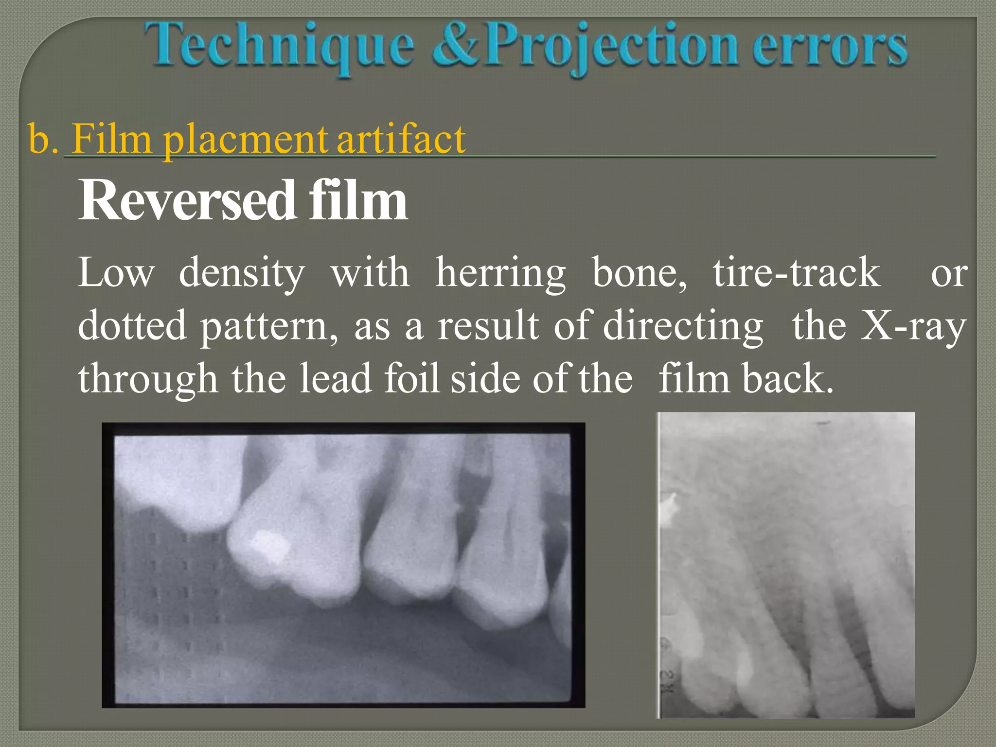 RADIOGRAPHIC ARTIFACTS | PPTX