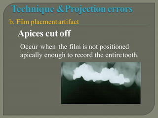 RADIOGRAPHIC ARTIFACTS | PPTX