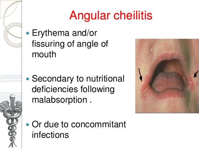 Mild Angular Cheilitis